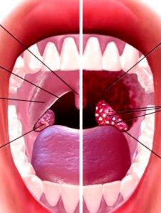 Faringitis - ALDIA | Noticias de Los Ríos, Ecuador y el mundo